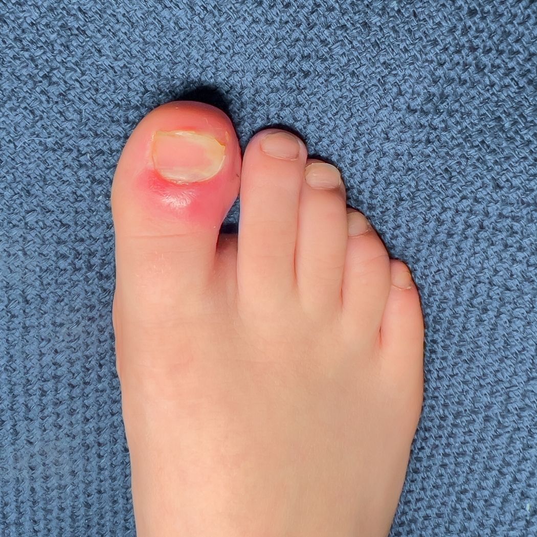 Skin and Nail Surgery - ARV Aesthetics